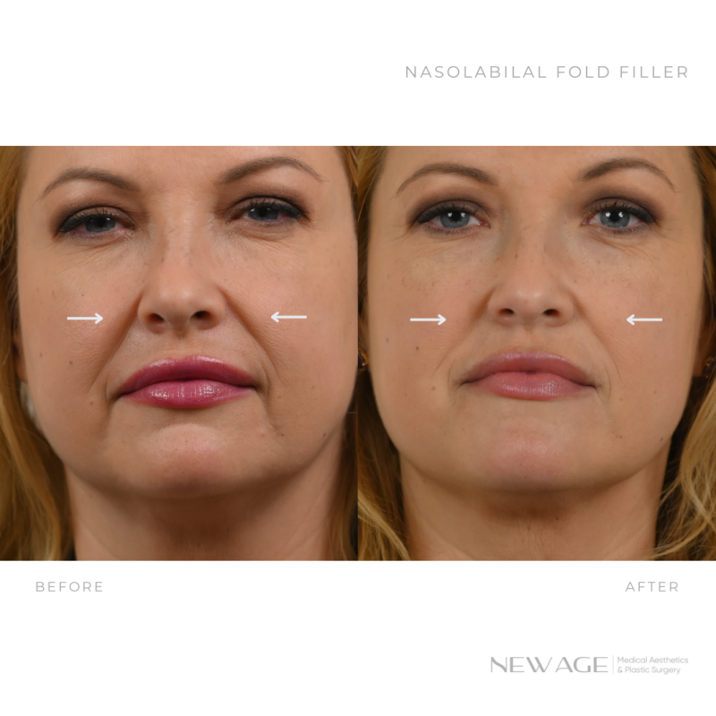 Nasolabial Fold | New Age Aesthetics