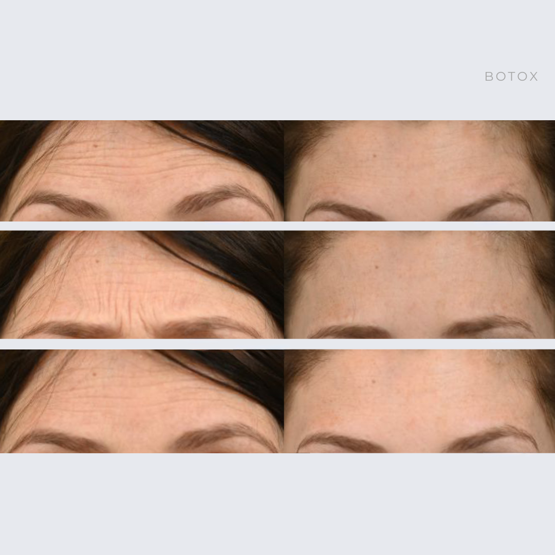 Botox | New Age Aesthetics